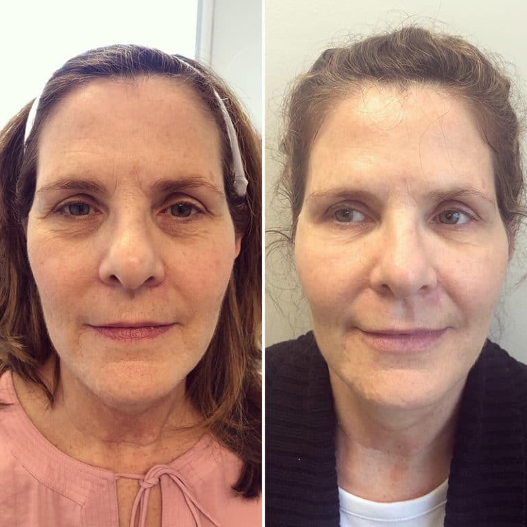 Wellesley Botox & Cosmetic Procedures | Dermatology Partners